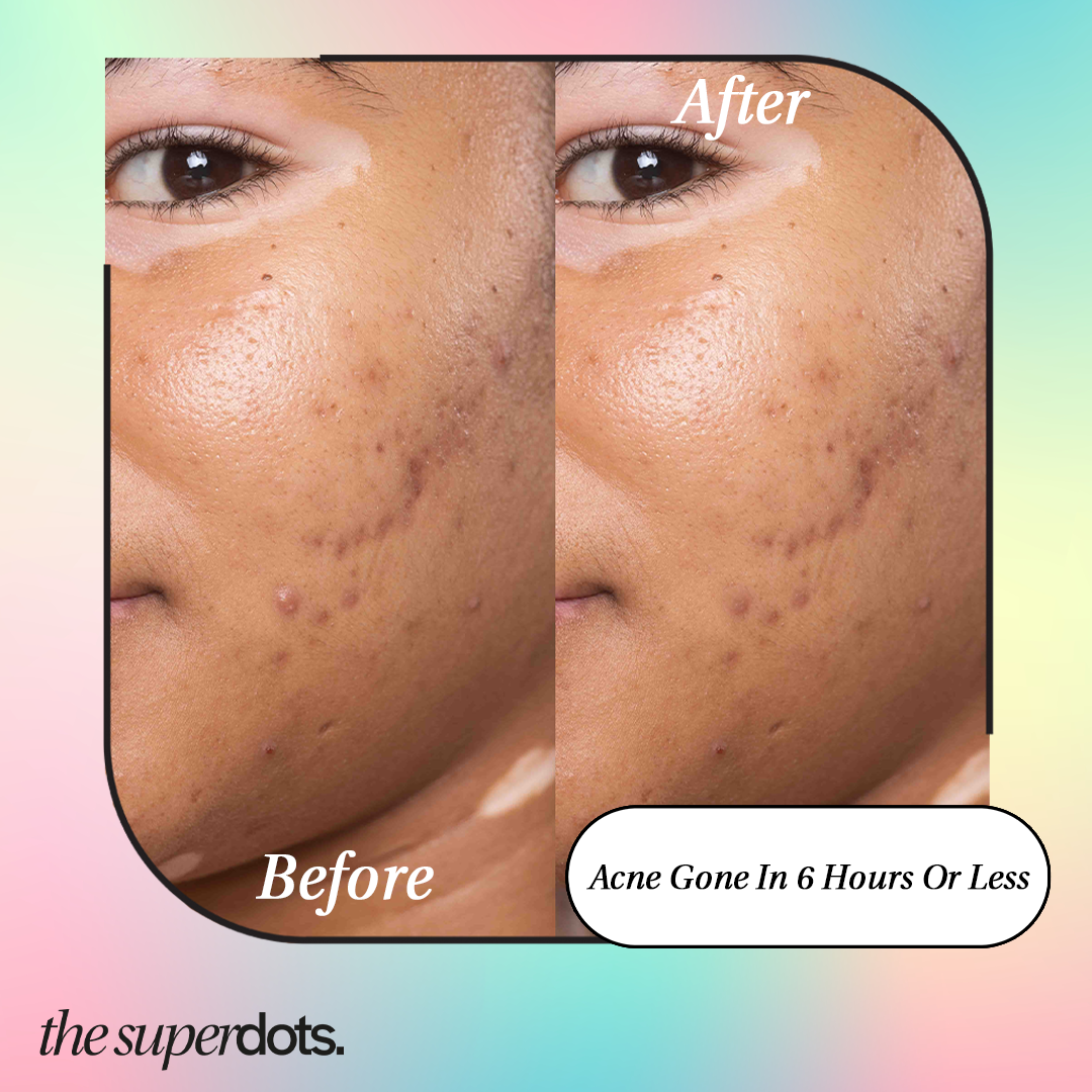Supercharged Clarifying Spot Patch – The Super Dots
